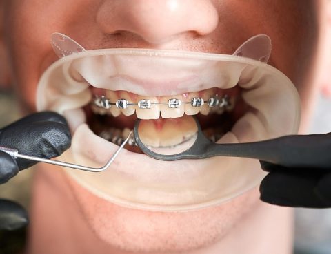 Ortodoncija – Dr Kalamanda Dajana